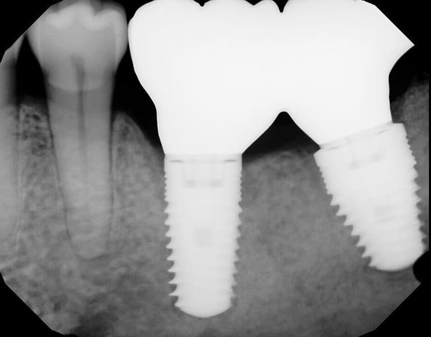 Video – Short, Narrow Dental Implants – Do They Work? | Ramsey A. Amin, DDS