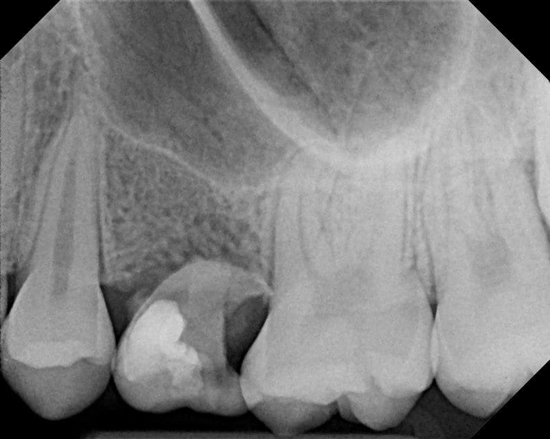 Dental Implants to Replace Baby Teeth | Ramsey A. Amin, DDS