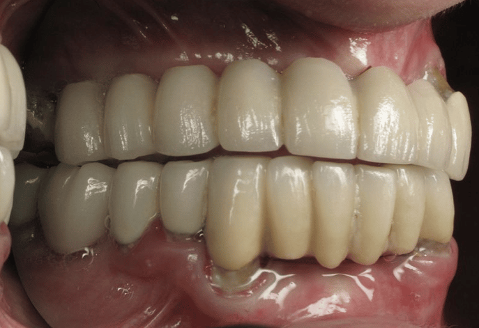 Prettau Dental Implant Full Mouth Bridge | Alternative to All-on-4 ...