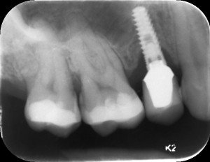 X-ray implant failing – Ramsey Amin, DDS