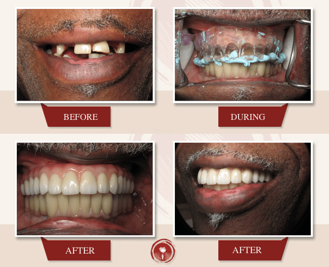 Prettau Dental Implant Full Mouth Bridge | Alternative to All-on-4 ...