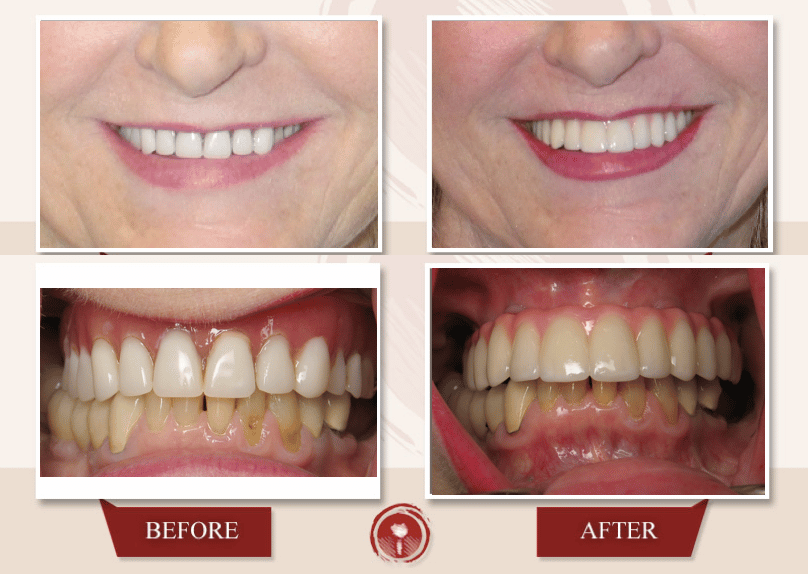 Prettau Dental Implant Full Mouth Bridge | Alternative to All-on-4 ...