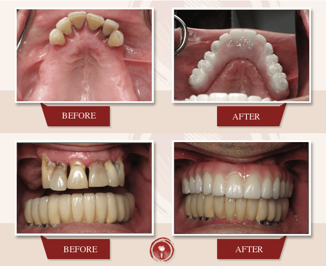 Prettau Dental Implant Full Mouth Bridge | Alternative to All-on-4 ...