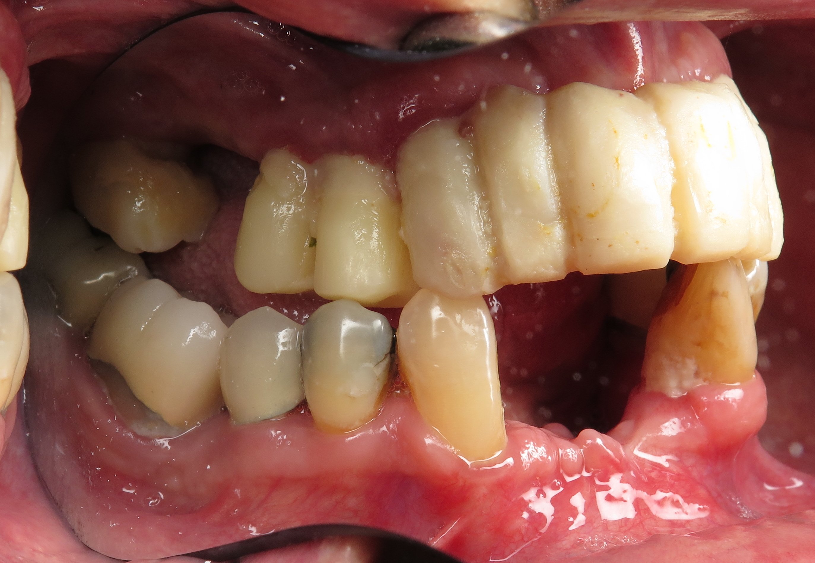 All On Dental Implants With Prettau Solid Zirconia Dental Implant ...