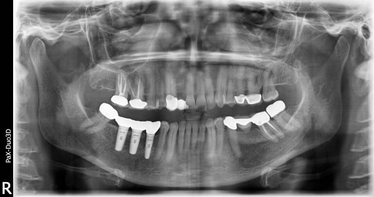 Replace Loose Long Bridge -Dental Implants And Bone Expansion | Ramsey ...