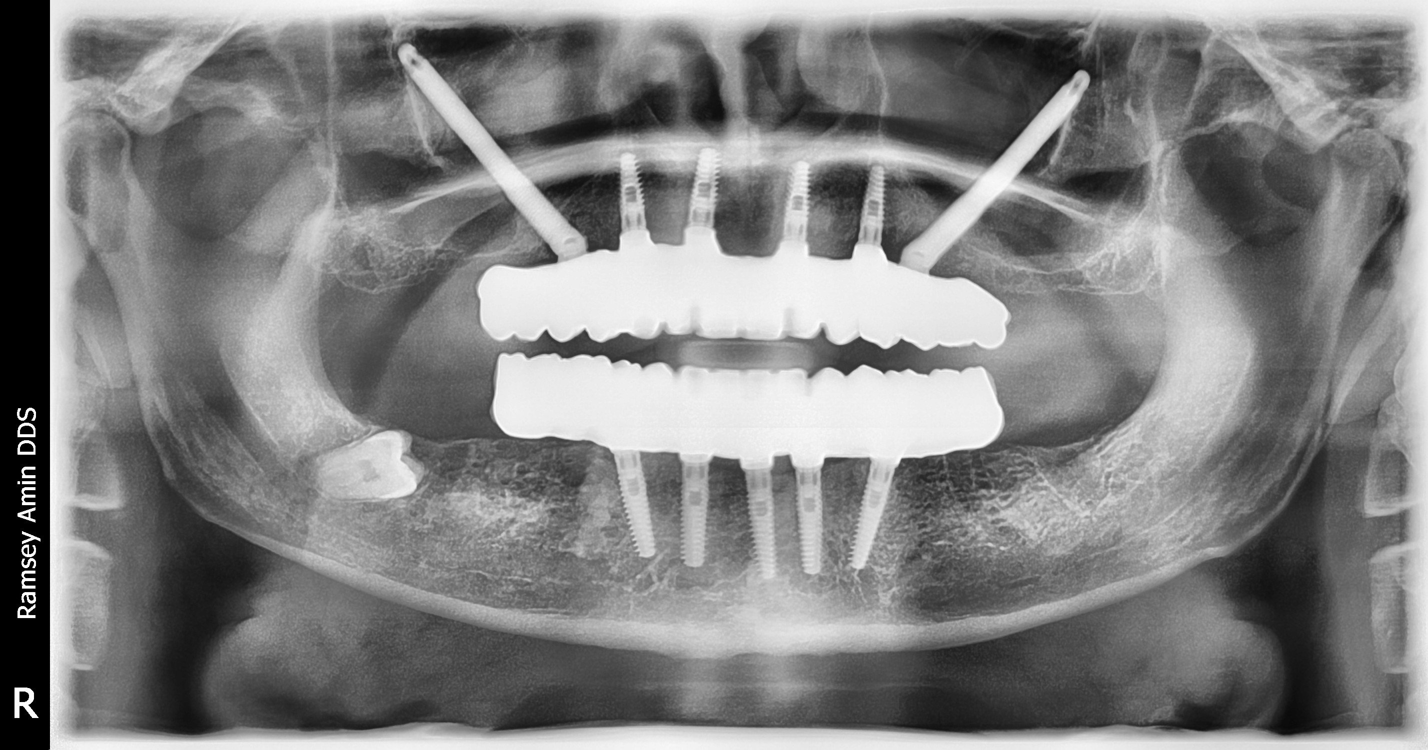 Zygomatic Implants | Ramsey A. Amin, DDS Zygomatic Implants | Ramsey A. Amin, DDS