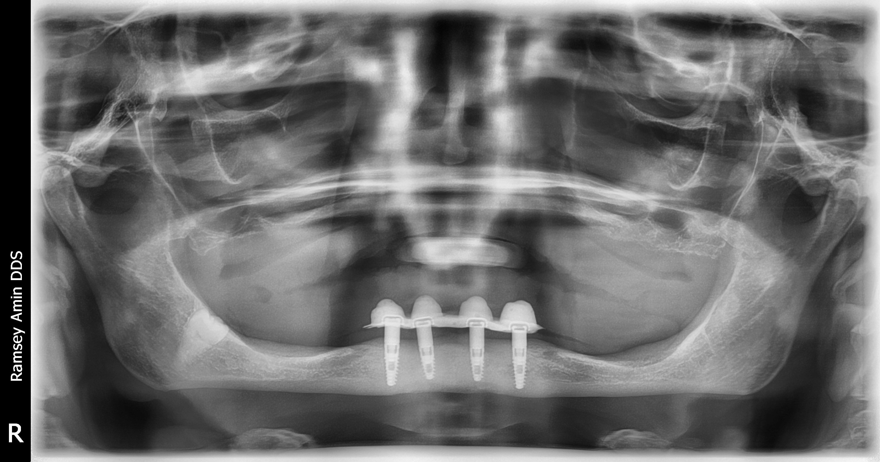 Complications-Bone Graft For Failed Full Lower Dental Implants | Ramsey ...