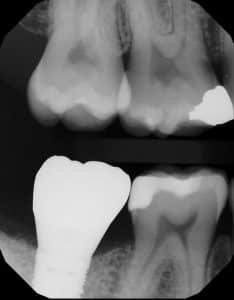 Last Molar Extracted… Do I Need A Dental Implant? | Ramsey Amin, DDS