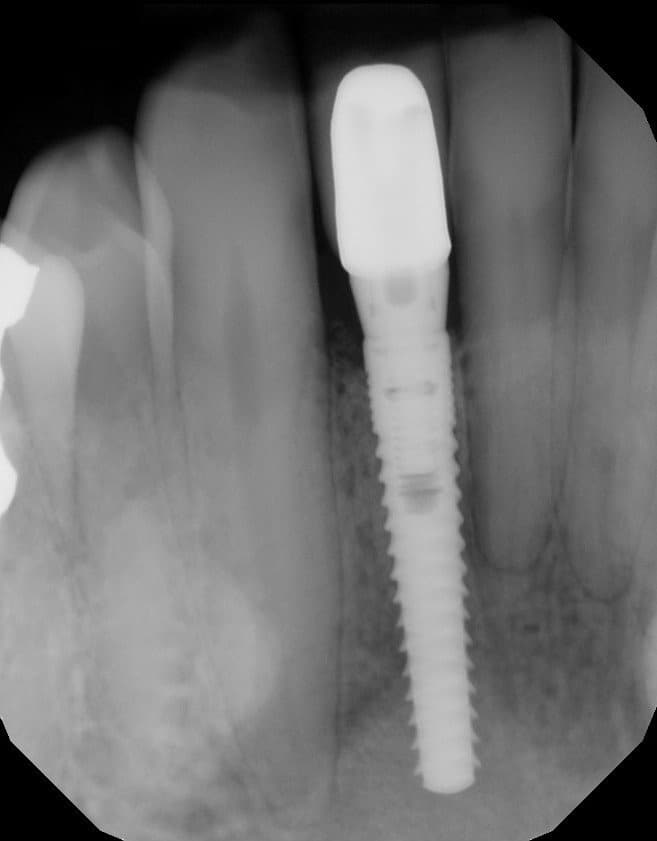 Lower Front Tooth Dental Implant –Immediate Tooth Replacement | Ramsey ...