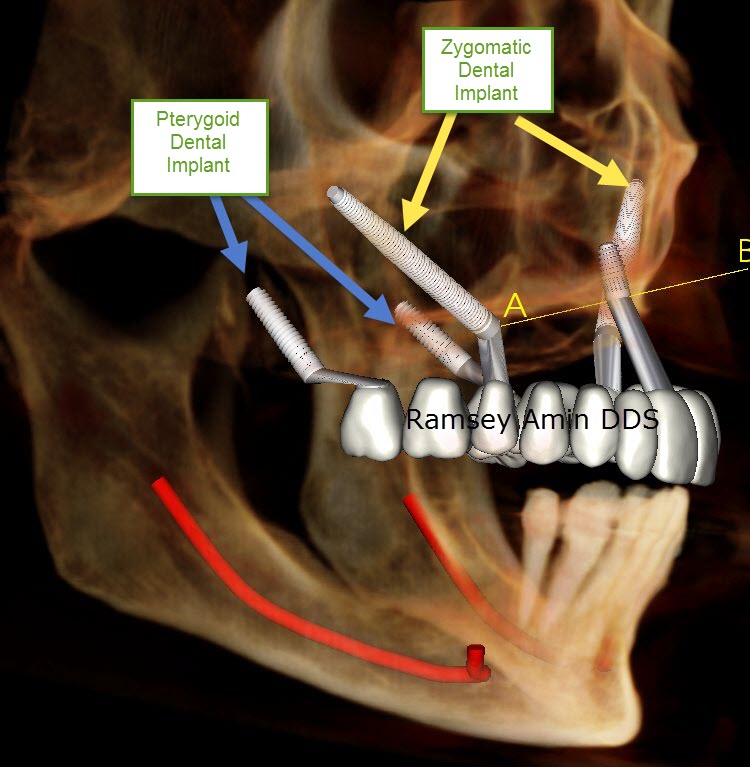 What is a Pterygoid Dental Implant? | Ramsey Amin, DDS