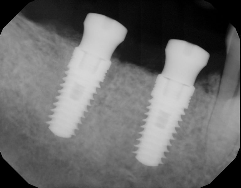 Is It Normal Extraction Bone Graft White Membrane Showing Ramsey Amin Dds