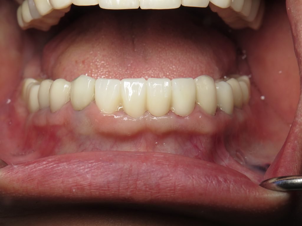 Immediate Implant Bridge Lower Jaw Front Teeth | Ramsey Amin, DDS