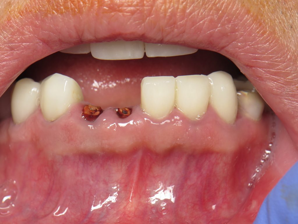 Immediate Implant Bridge Lower Jaw Front Teeth | Ramsey Amin, DDS