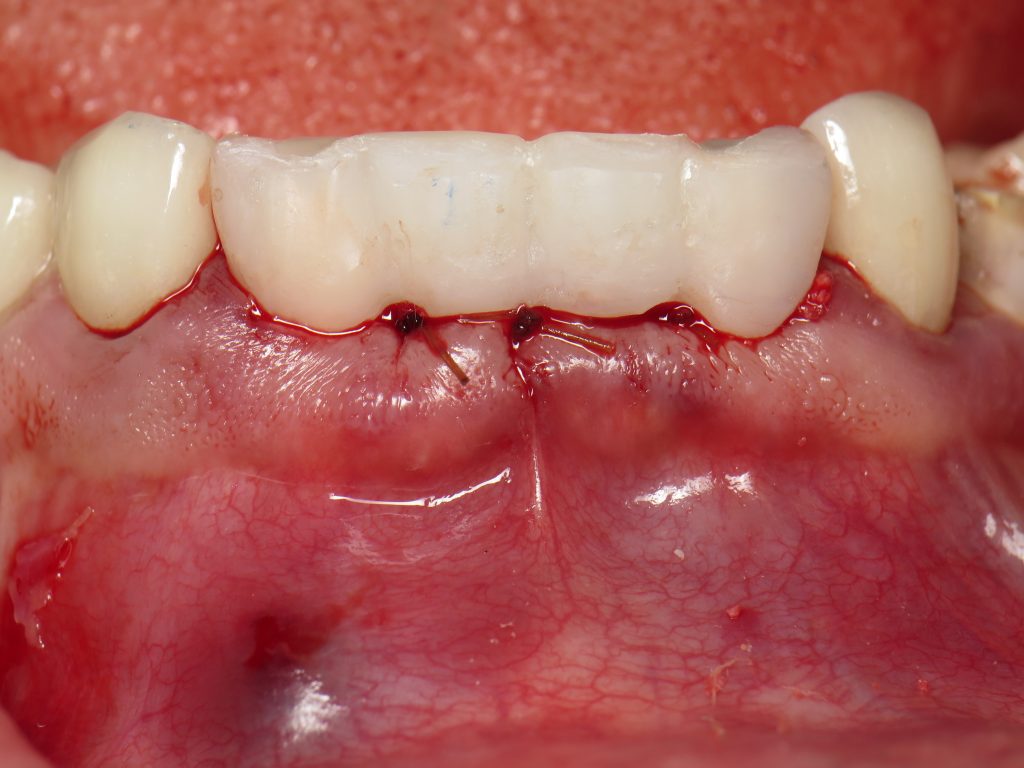 Immediate Implant Bridge Lower Jaw Front Teeth | Ramsey Amin, DDS